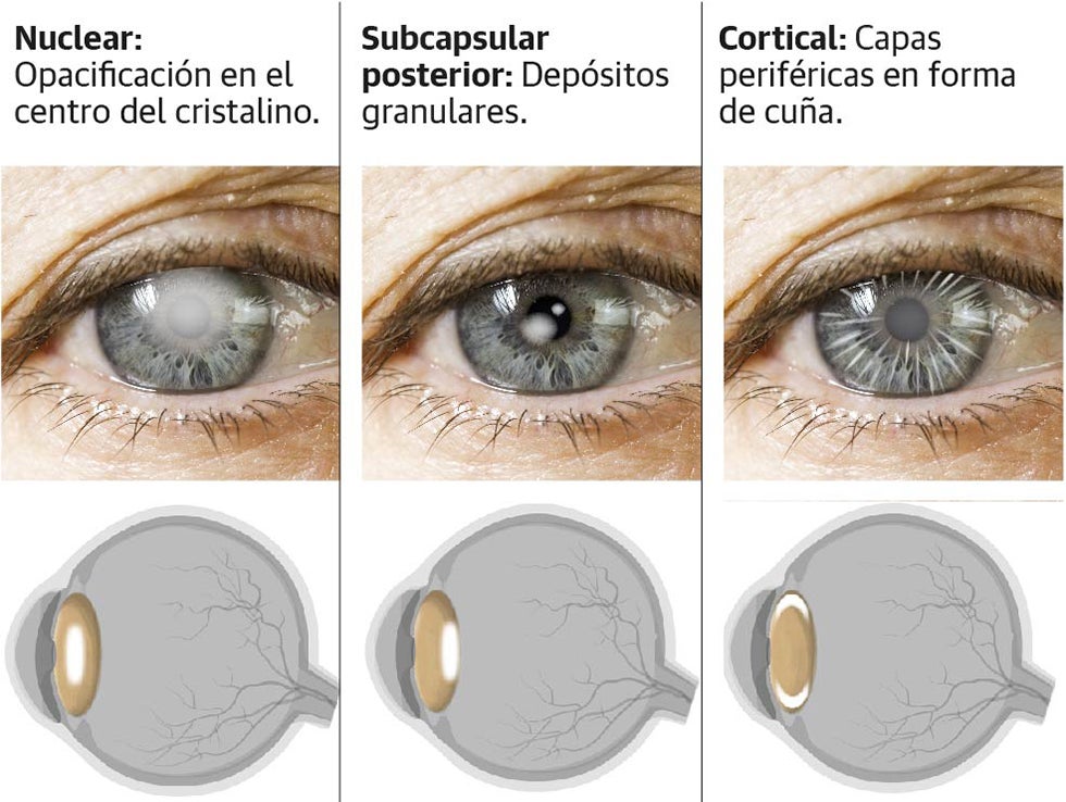 Así ve una persona con cataratas | El Correo